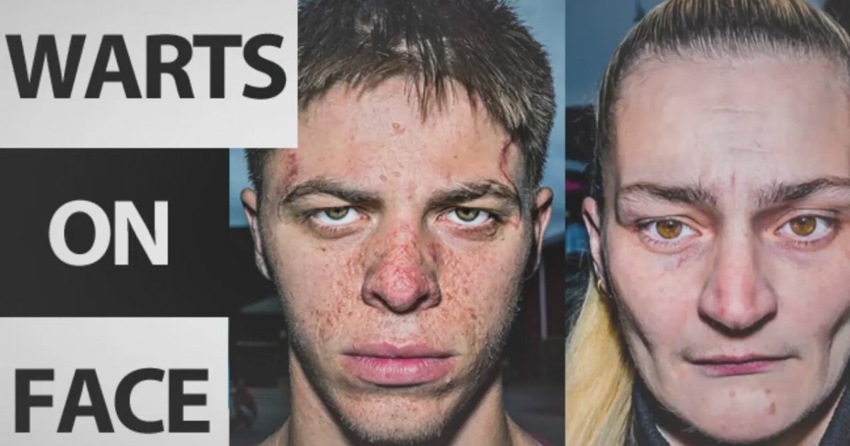 Wart Removal: How to Remove Warts On Face Fast & Naturally at Home ...